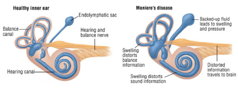 Meniere's Disease - Pacific Eye & Ear Specialists